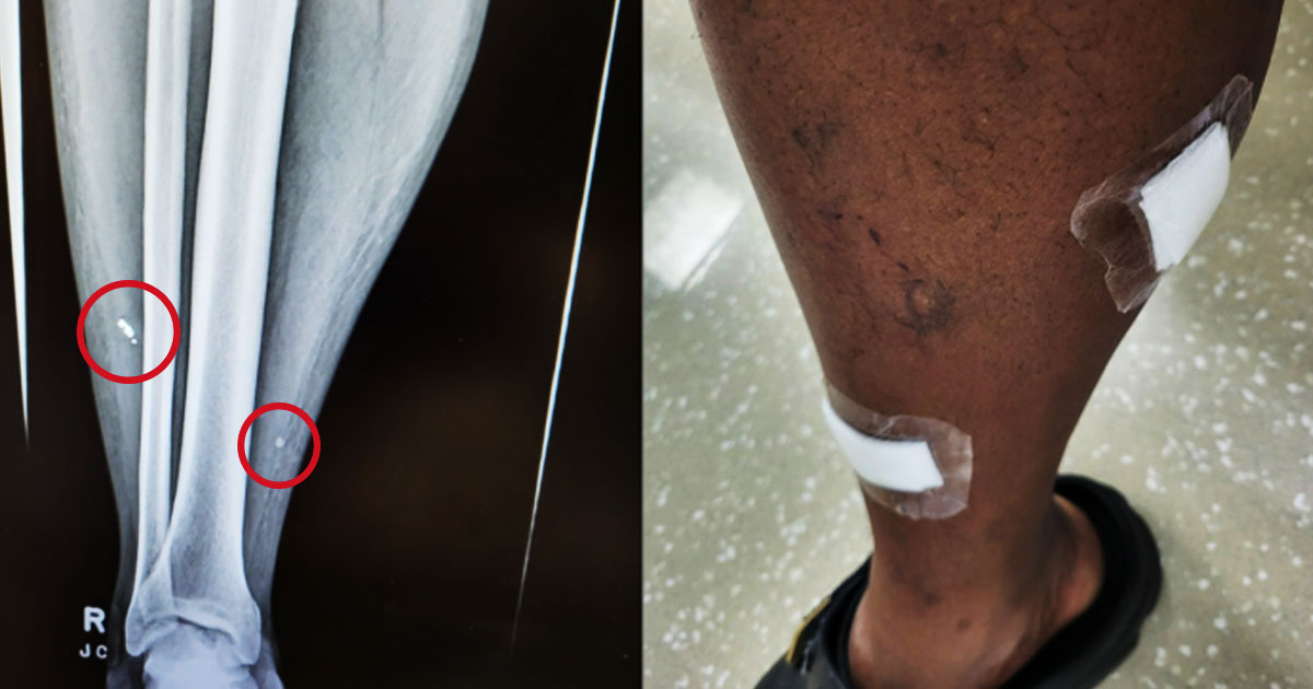 Negligent Discharge After Dropped Gun at Cracker Barrel Ends in ...